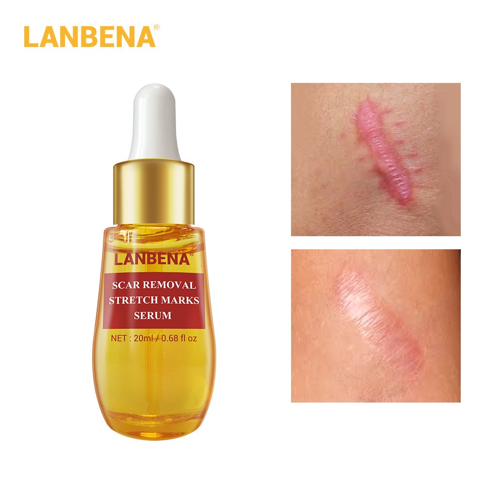 LANBENA Remover Stretch Marks Acne Scar Remove Serum Acne Treatment ...
