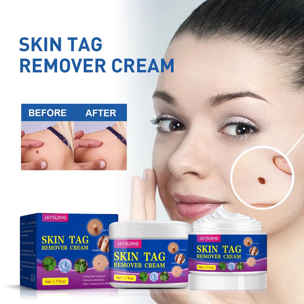 Mole Tag Wart Remover Ointment Antibacterial Solution Remove Fleshy ...