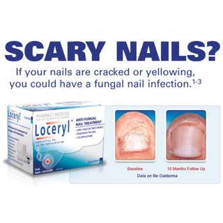 LOCERYL NAIL LACQUER - Proven Anti-Fungal Nail Treatment | Shopee Singapore