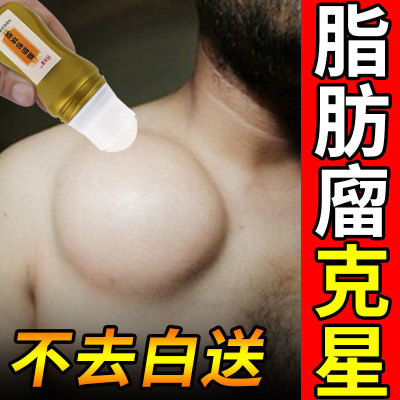 Lipoma Special Plaster Peeling Lipoma Multiple Single Lipoma Lump Lump ...