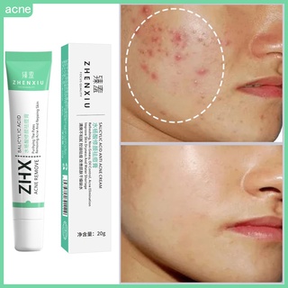 Salicylic Acid Acne Cream Remove Blackhead Oil Control Anti-Acne ...