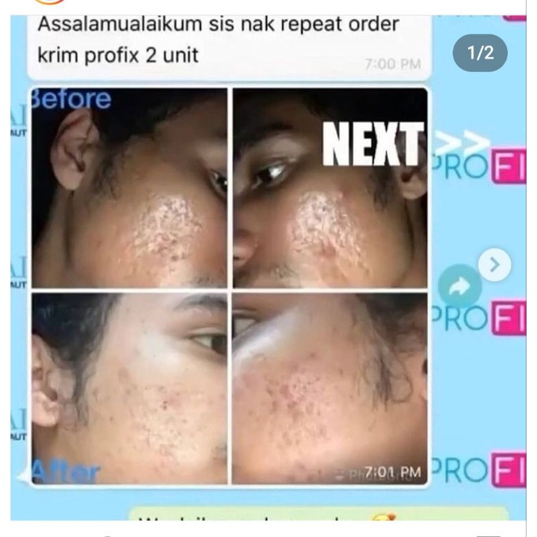 Profix Qalish Parut Acne Scars Breakouts Pores Skin Problems | Shopee ...
