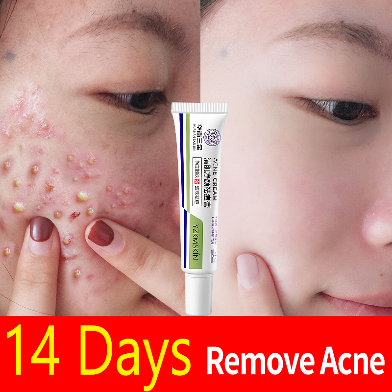 Acne Scar Treatment Cream Acne Treatment Serum Anti Acne Scar Removal ...
